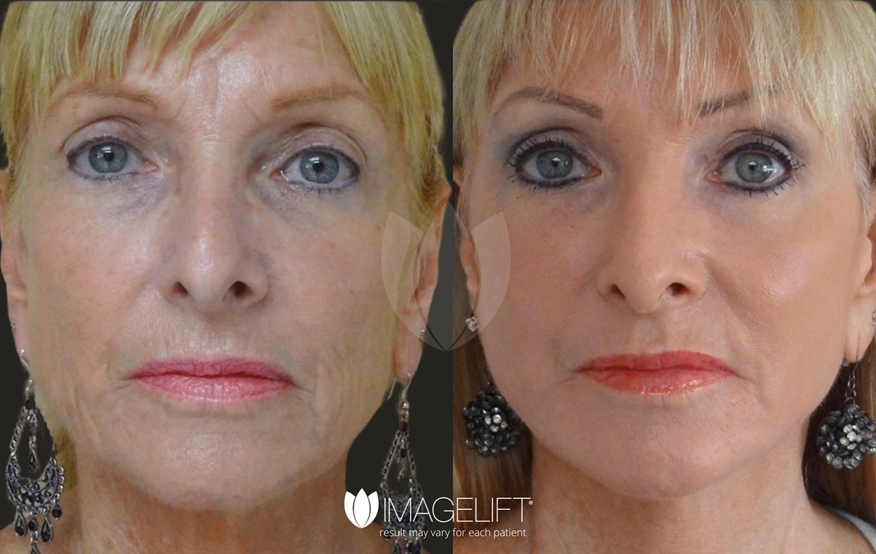 Before & After Photos Liquid Lift | ImageLift™