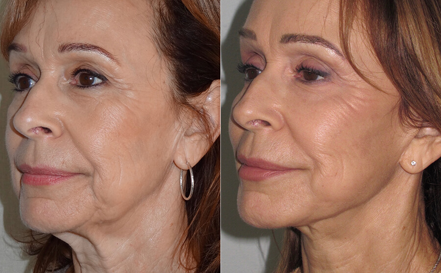 Image Lift Facelift Patient 23 | Dr. Castellano ImageLift Plastic ...