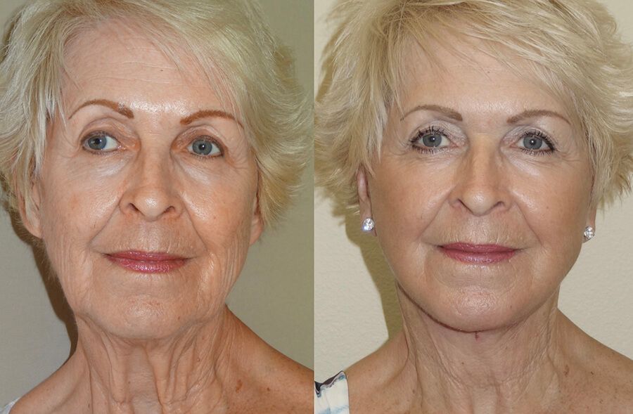 Image Lift Facelift Patient 30 | Dr. Castellano ImageLift Plastic ...