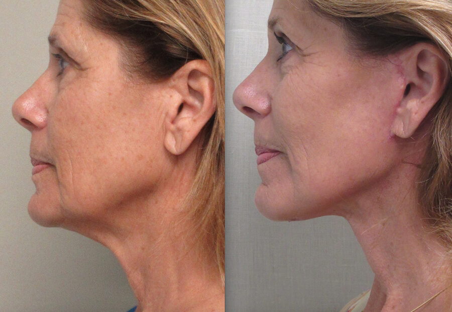 Before & After Photos Image Lift Facelift | ImageLift™