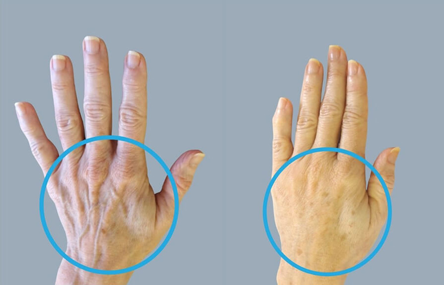 Before & After Photos Hand Rejuvenation | ImageLift™